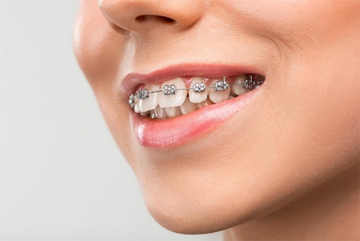 Ventajas de los brackets estéticos